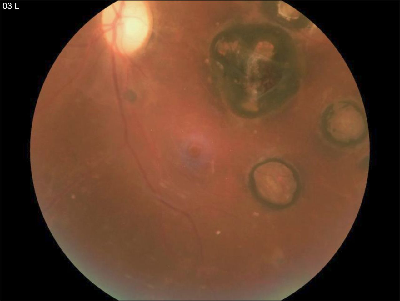 Comparative evaluation of funduscopy, PCR and serology in the diagnosis ...