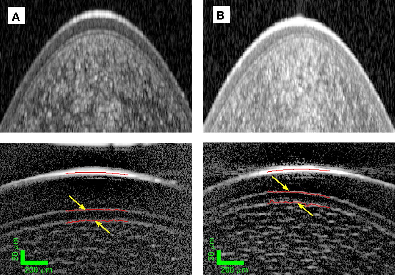 Bowman’s layer and corneal thickness in health and disease | BMJ Open ...