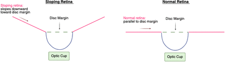Sloping retina: a novel feature associated with primary open-angle ...