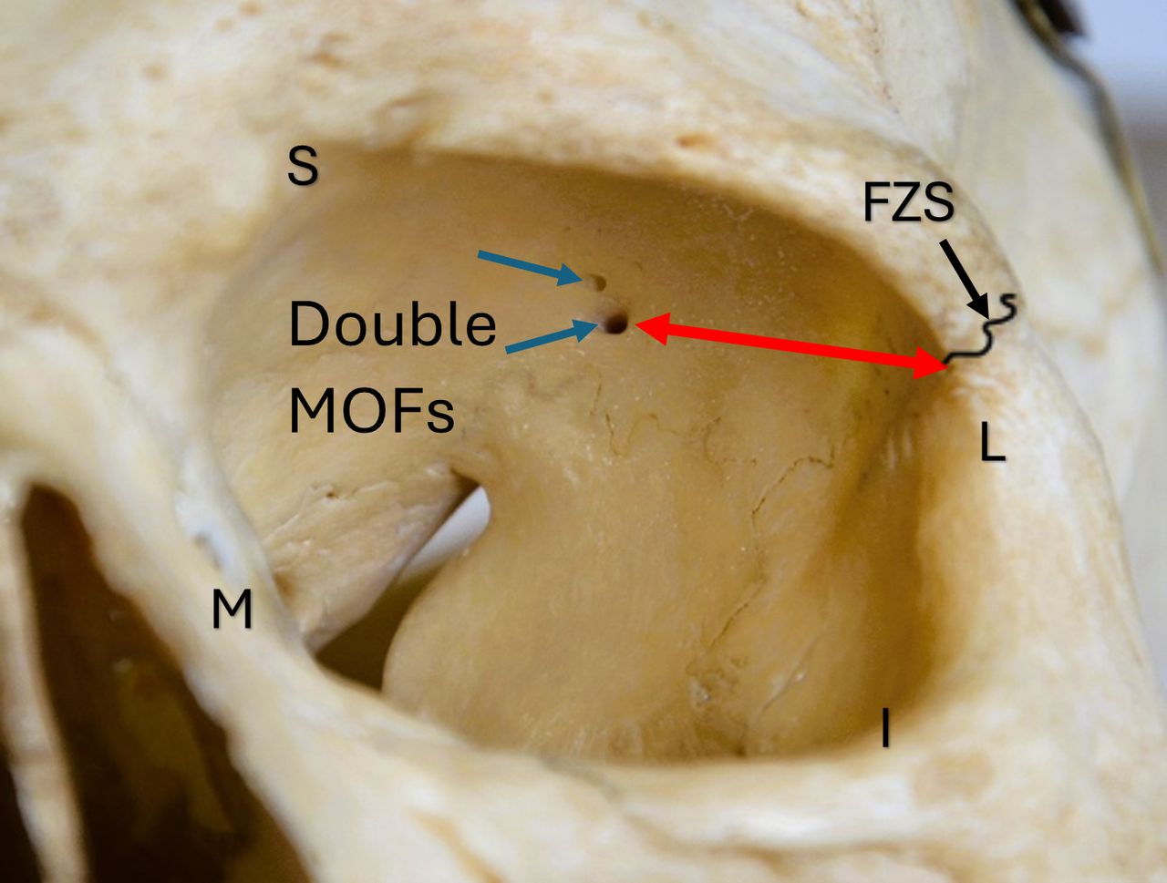 Anatomical insights: meningo-orbital foramen and its clinical relevance ...