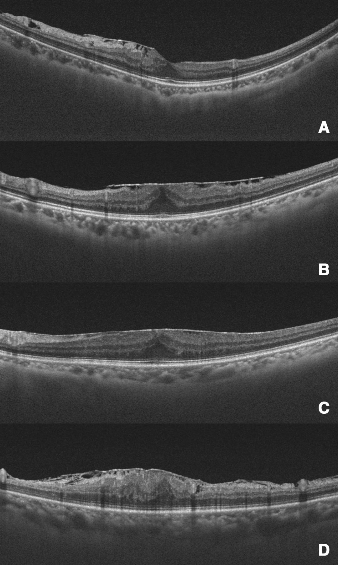 Relationship between morphological changes in the foveal avascular zone ...