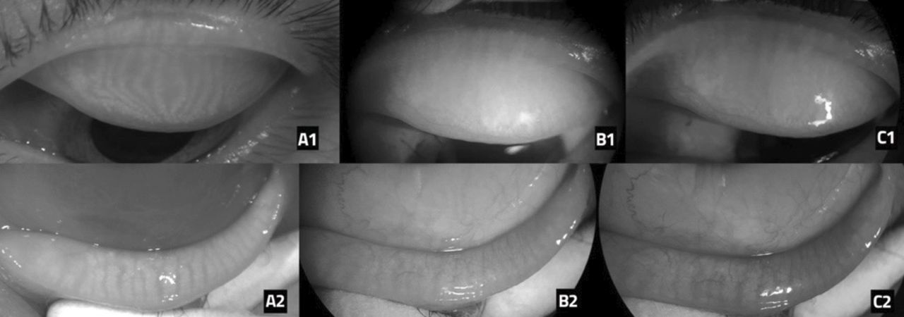 Red filter meibography by smartphones in patients with meibomian gland ...