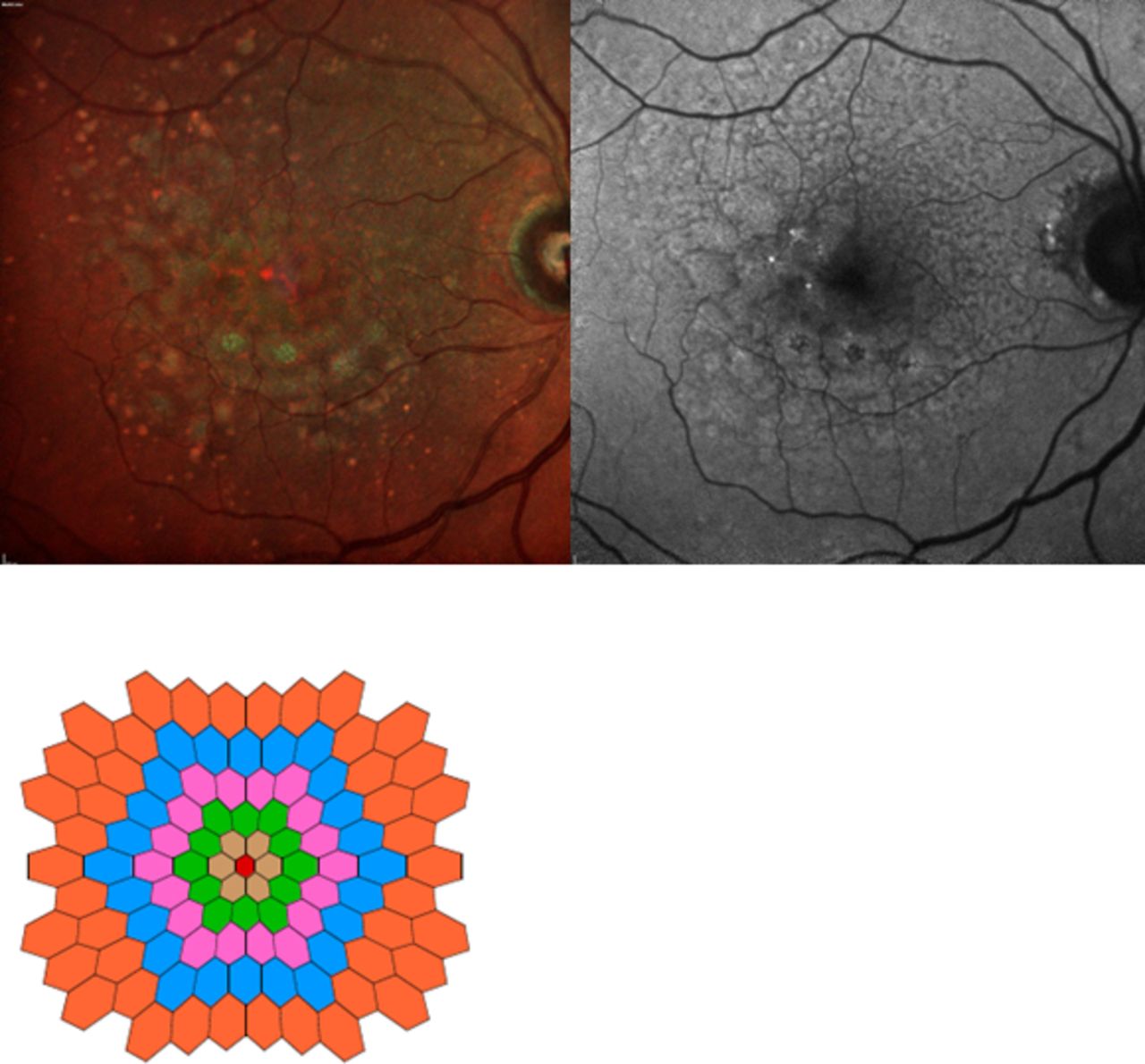 Saffron therapy for the ongoing treatment of age-related macular ...