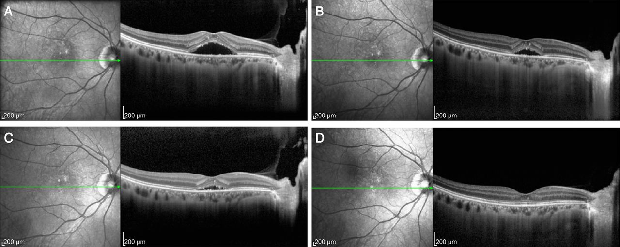 Selective retina therapy with real-time feedback-controlled technology ...