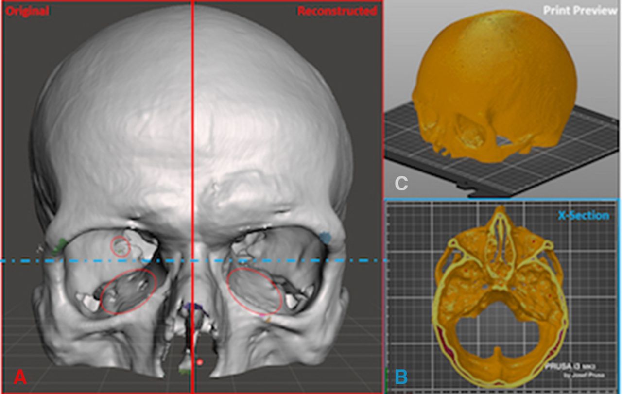 Image-guided orbital surgery: a preclinical validation study using a ...