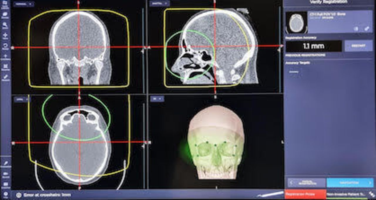 Image-guided orbital surgery: a preclinical validation study using a ...