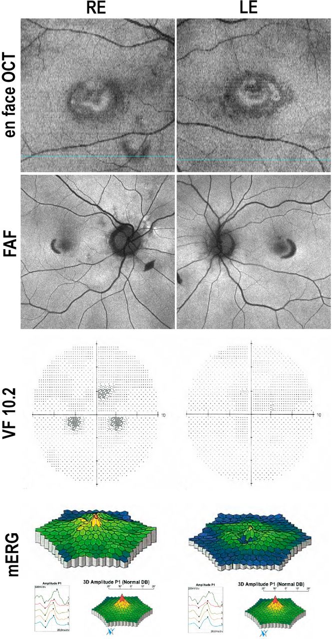 New proposal for a multimodal imaging approach for the subclinical ...